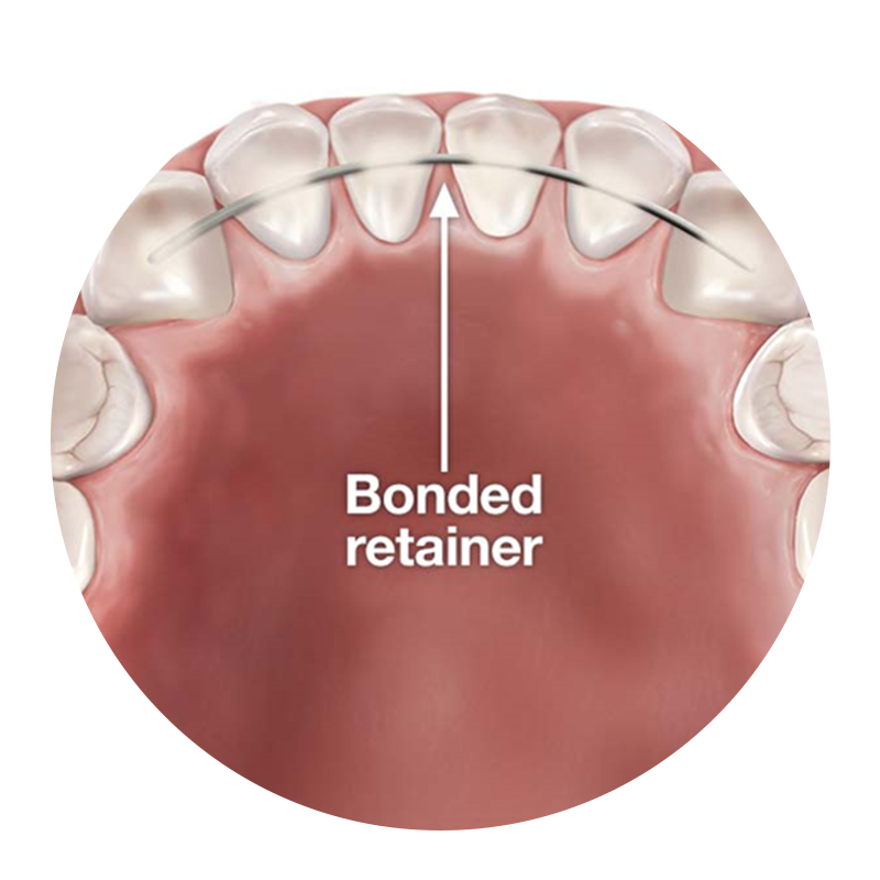 Retainers | Insoft & Hurst Orthodontics