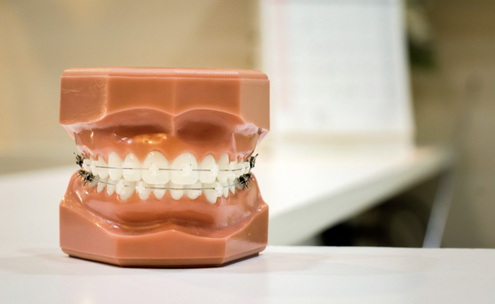 How clear are clear braces? | Insoft & Hurst Orthodontics